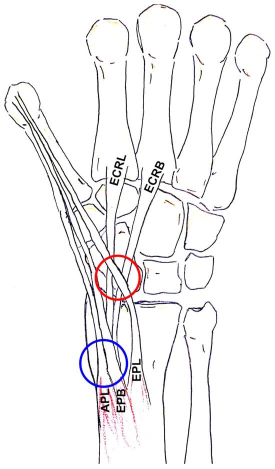 Distal Intersection Tenosynovitis: Surgical Insights From Five Cases | MDPI