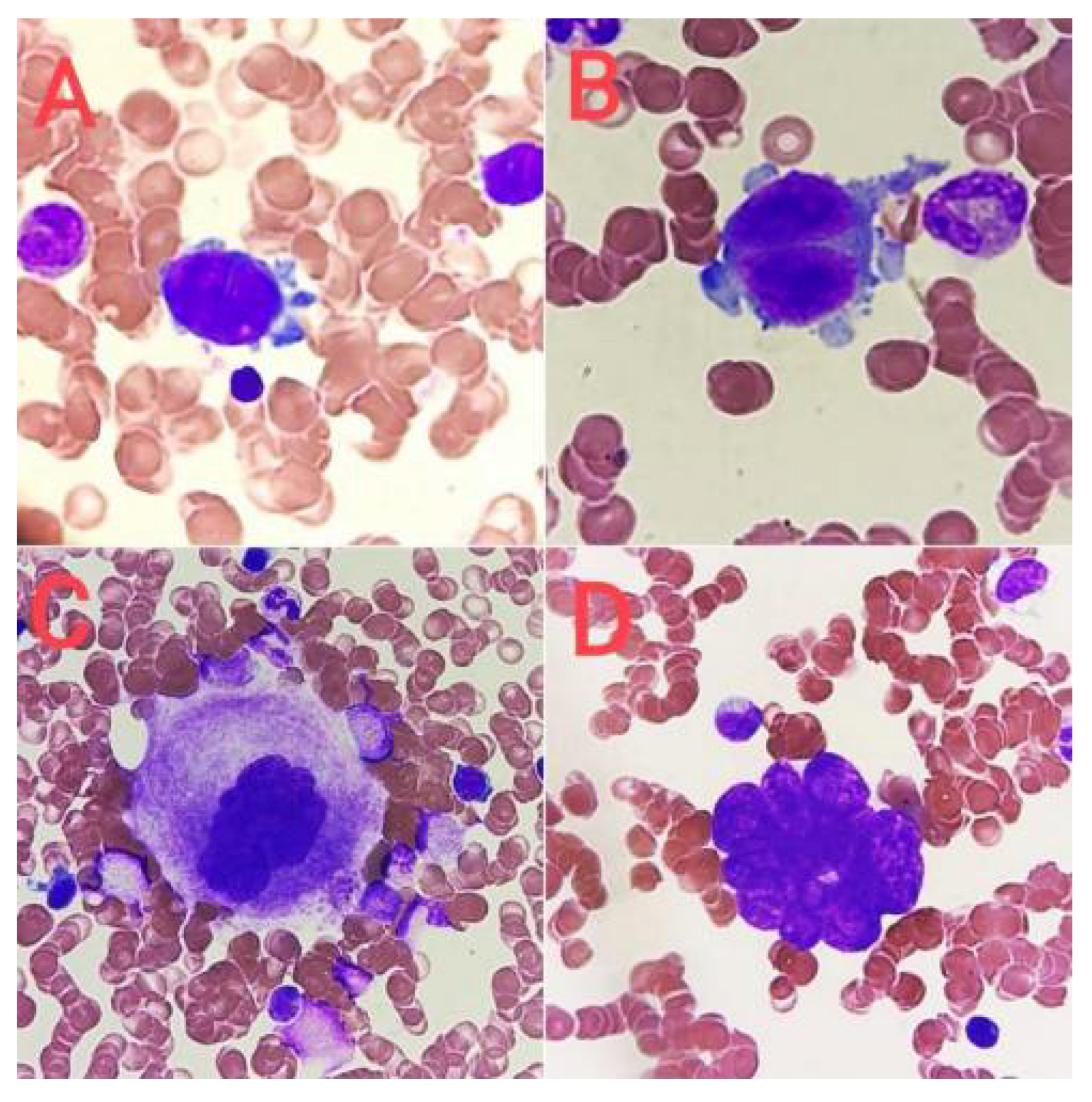 The Role of Megakaryocyte Assessment in Bone Marrow Cytology | MDPI