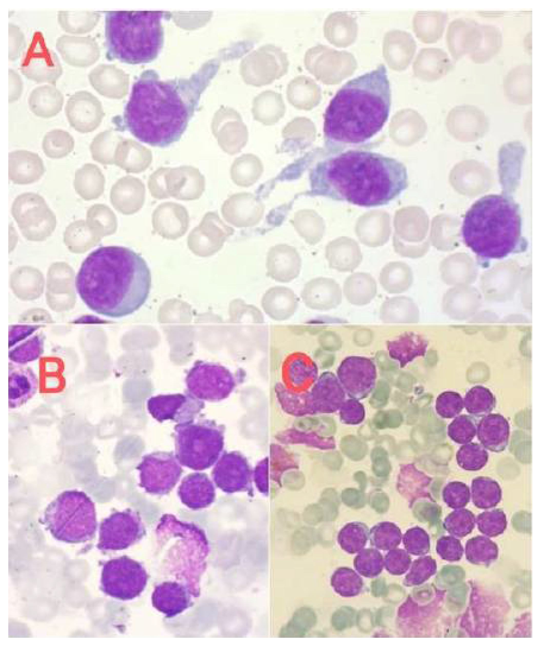 The Role of Megakaryocyte Assessment in Bone Marrow Cytology | MDPI