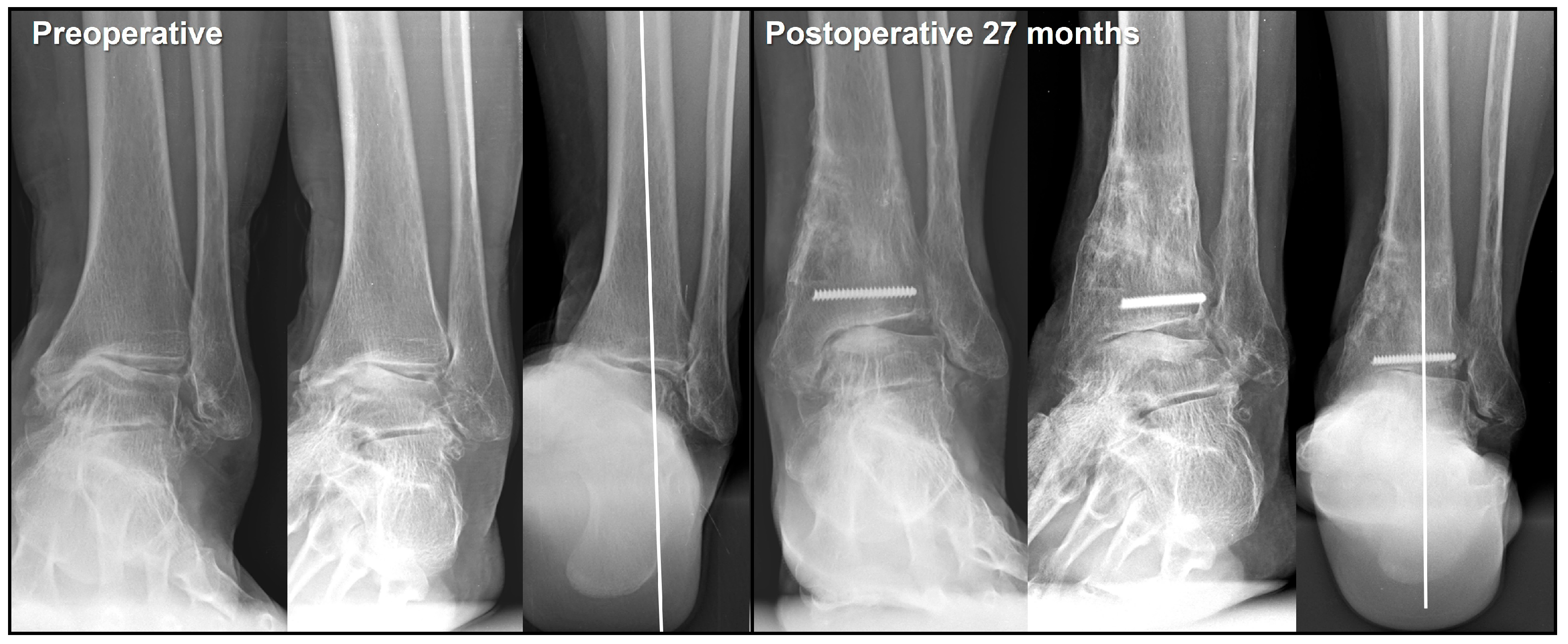 Surgical Correction of Large Talar Tilt in Varus Ankle Osteoarthritis ...