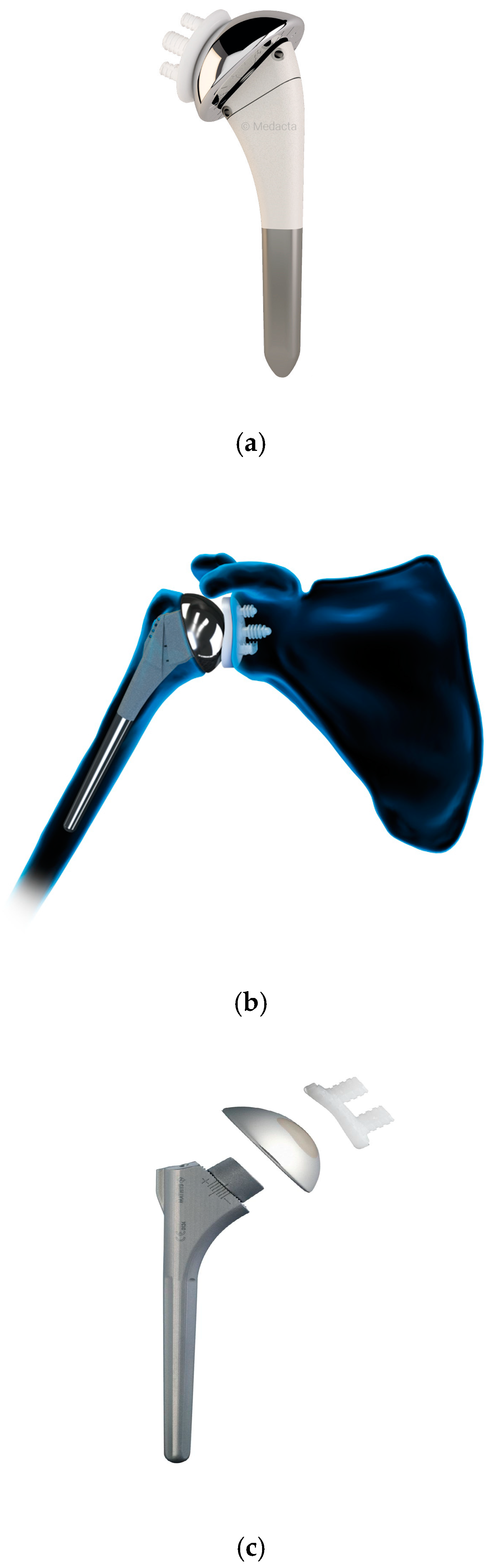 Trends in Shoulder Arthroplasty: A Narrative Review of Predominant ...