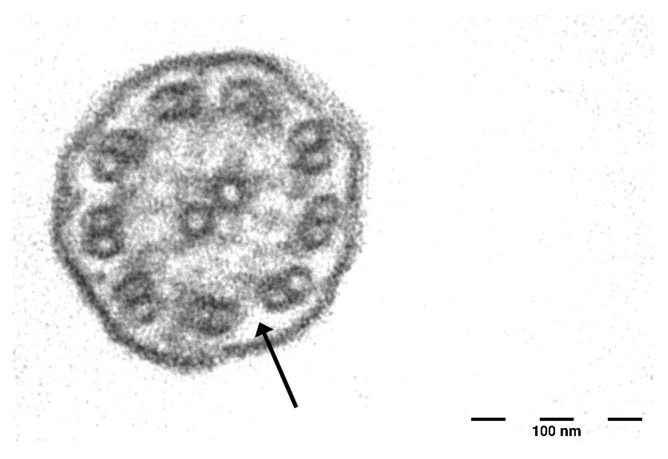 Bilateral Sensorineural Hearing Loss in a Patient with Primary Ciliary ...