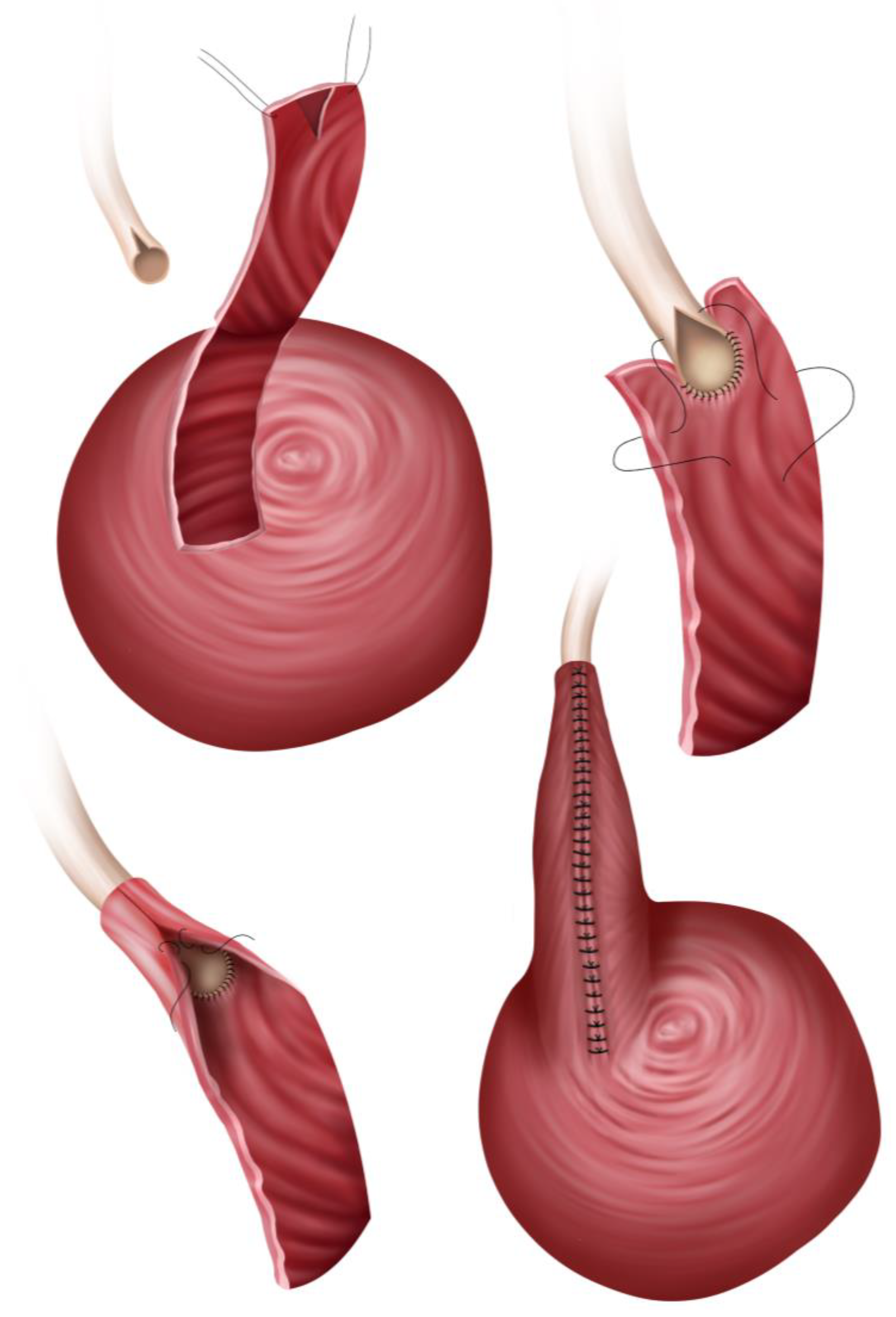 Ureteric Complications and Urinary Tract Reconstruction Techniques in ...