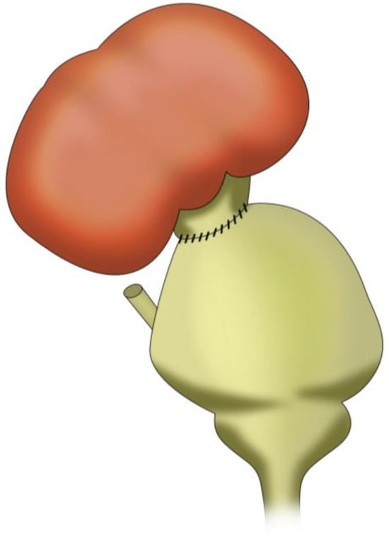 Ureteric Complications and Urinary Tract Reconstruction Techniques in ...