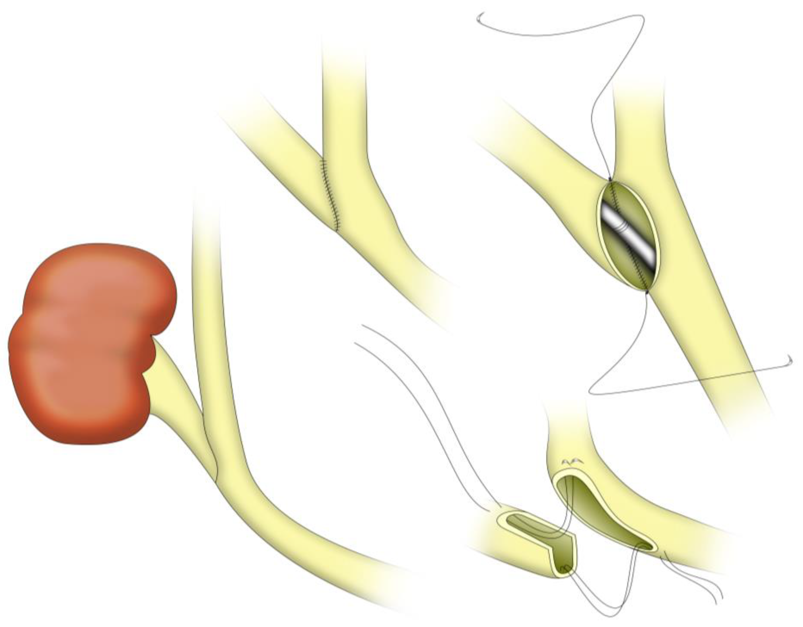 Ureteric Complications and Urinary Tract Reconstruction Techniques in ...