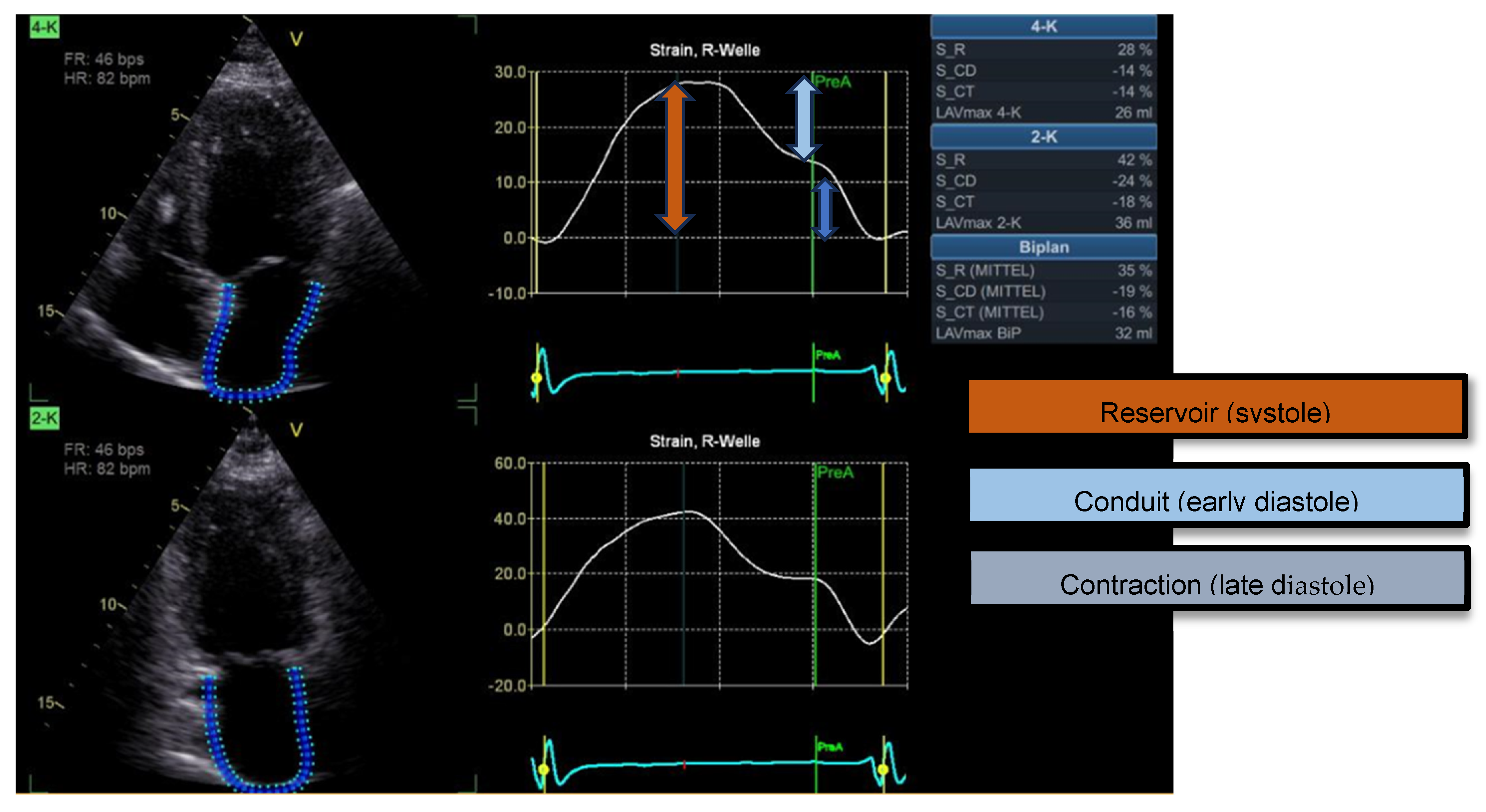 Effects of Cardiac Contractility Modulation on Right Ventricular and ...