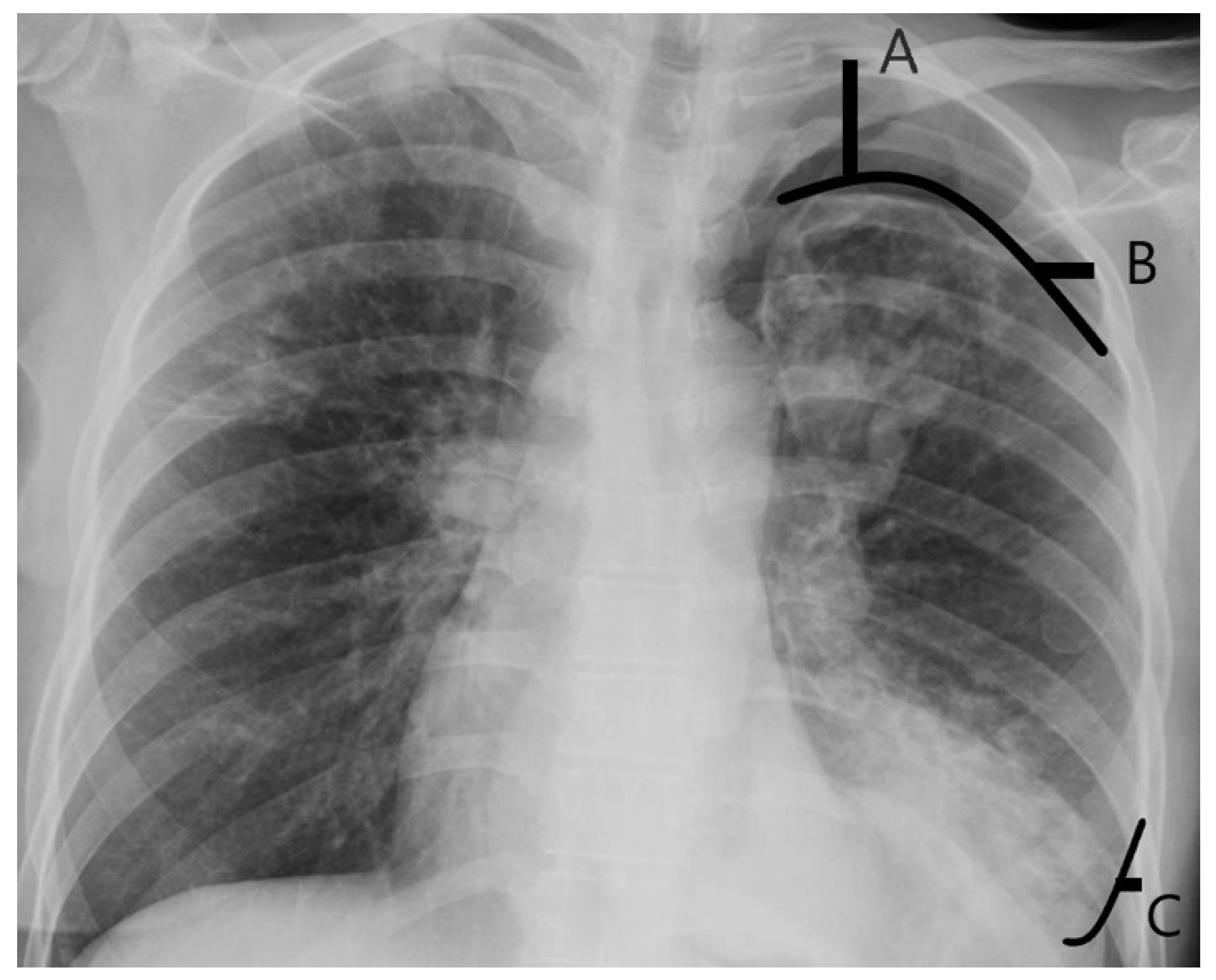 Predictors and Potential Clinical Implications of Residual ...