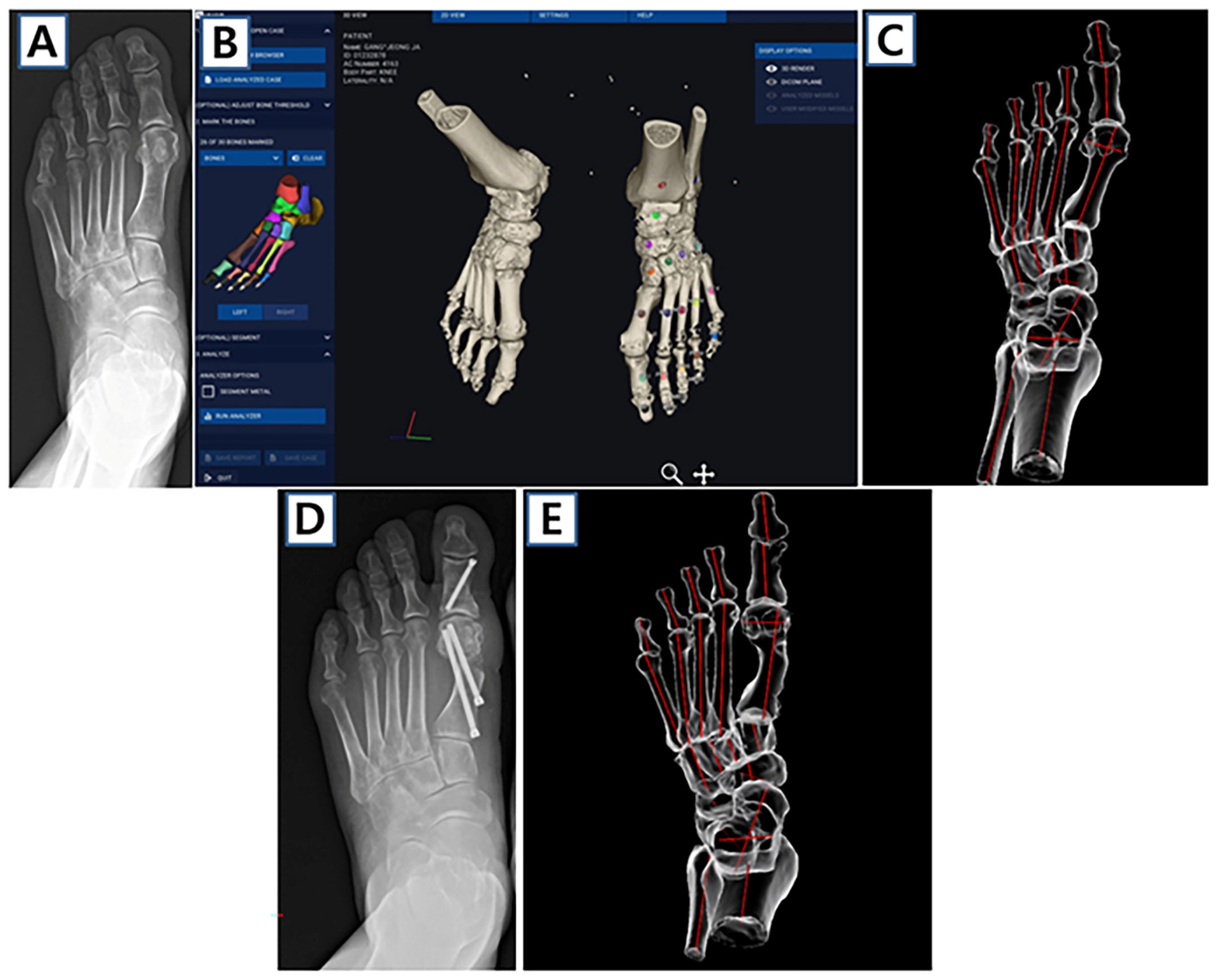 Current Concepts of Radiographic Evaluation and Surgical Treatment for ...