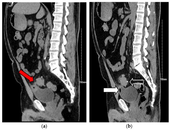 Comparison of Open Versus Minimally Invasive Repair of Colovesical ...