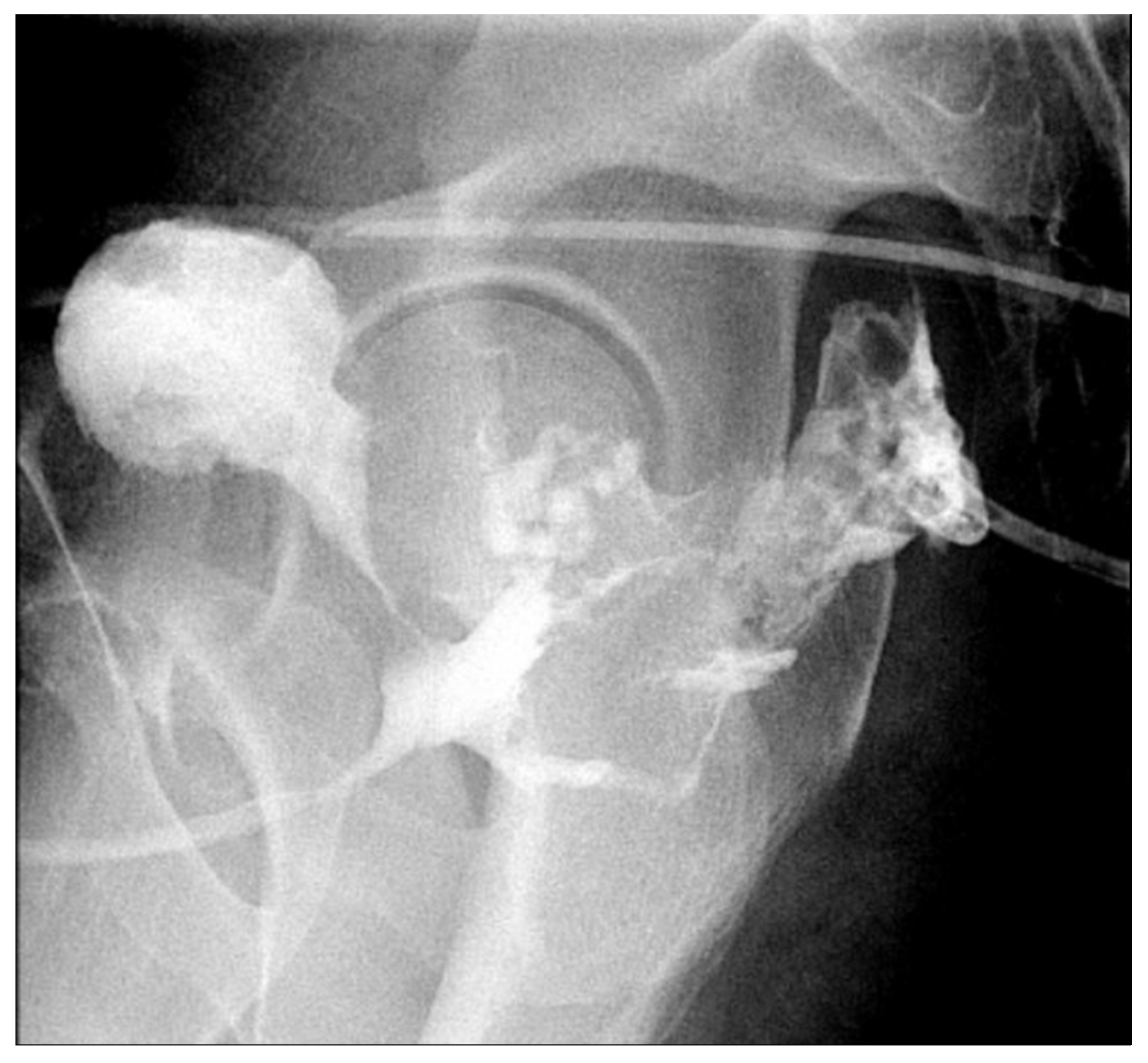 Comparison of Open Versus Minimally Invasive Repair of Colovesical ...