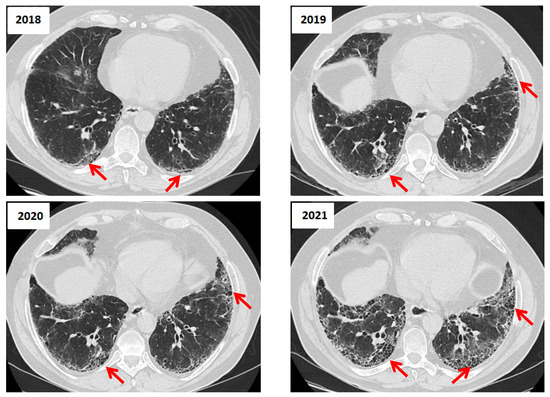 High-Resolution CT Findings in Interstitial Lung Disease Associated ...