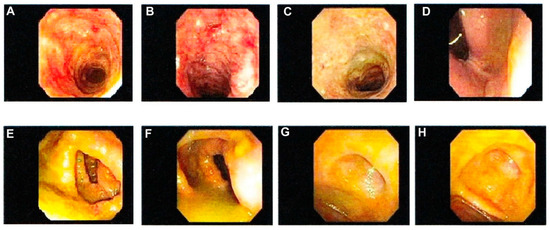 Secure Ileal Pouch–Anal Anastomosis for Histologic Indeterminate ...