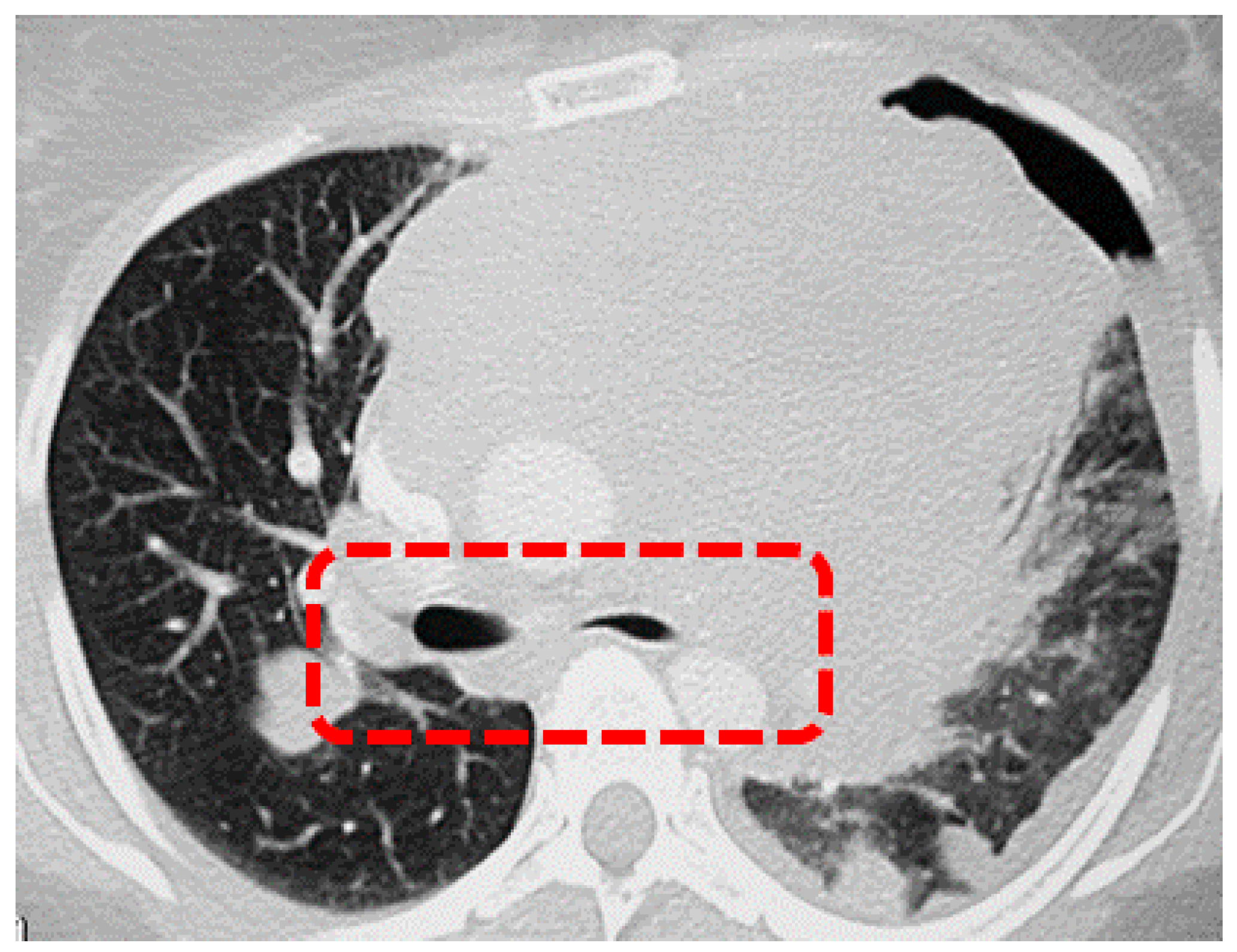 From Awake to Minimalist Spontaneous Ventilation Thoracoscopic ...