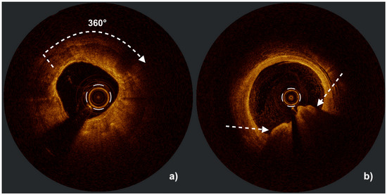 Management of Calcified Coronary Lesions—A Review of Plaque ...