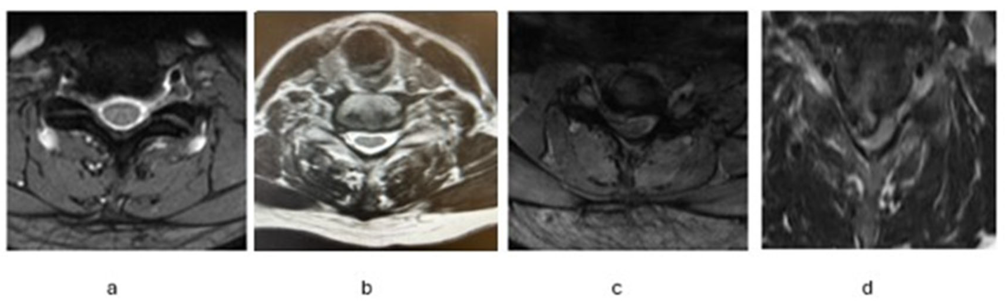 Does the Size of Cervical Disc Herniation Affect Clinical Parameters in ...
