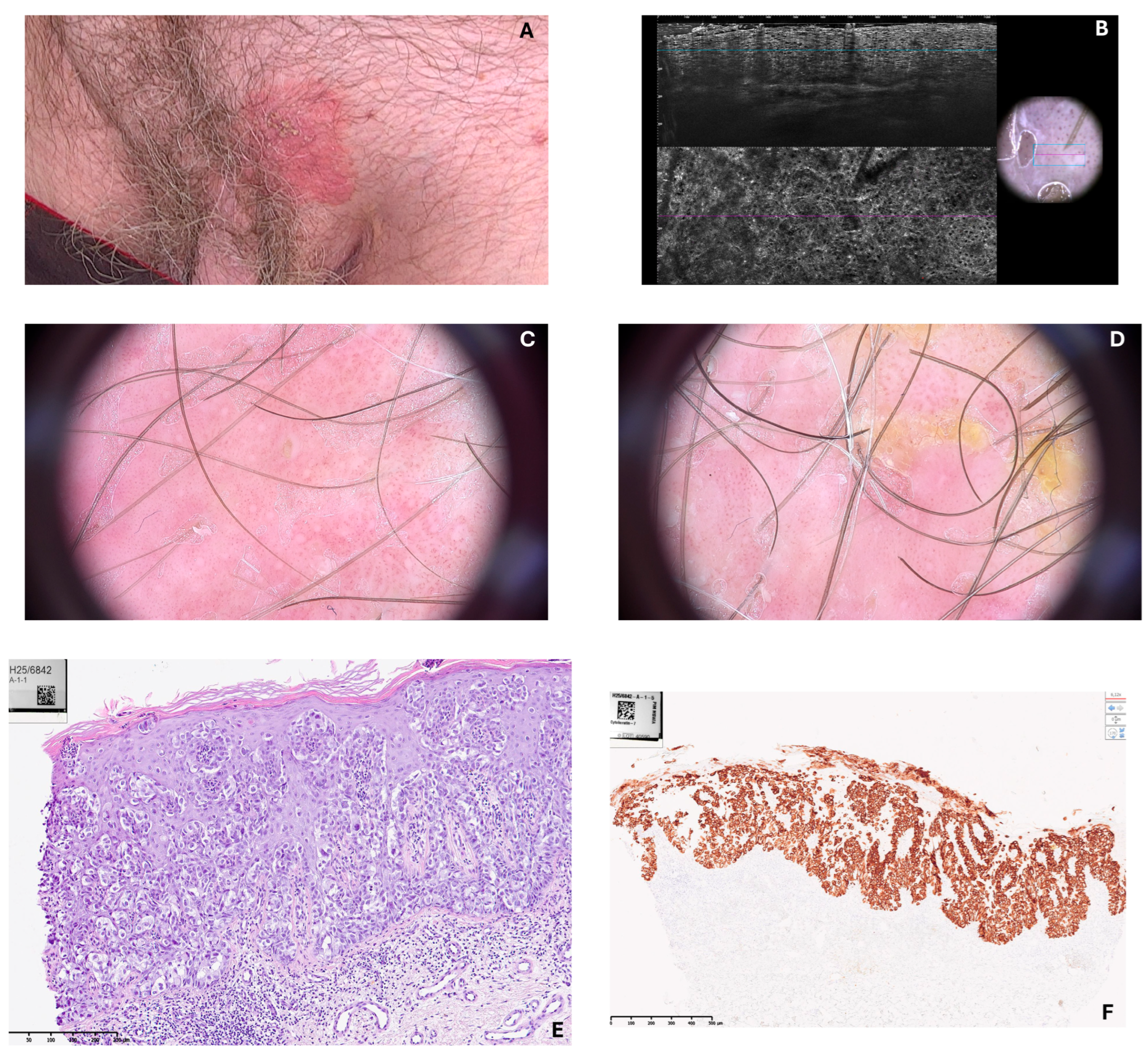 Extramammary Paget’s Disease of the Suprapubic Region in a Male: A ...