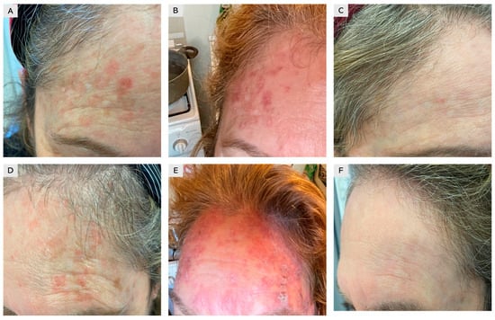 Efficacy of 4% 5-Fluorouracil Cream in the Treatment of Actinic ...