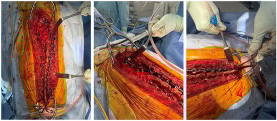 CT-Based Analysis of Rod Trace Length Changes During Posterior Spinal ...