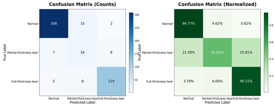 Patient-Level Classification of Rotator Cuff Tears on Shoulder MRI ...