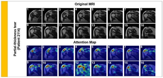 Patient-Level Classification of Rotator Cuff Tears on Shoulder MRI ...