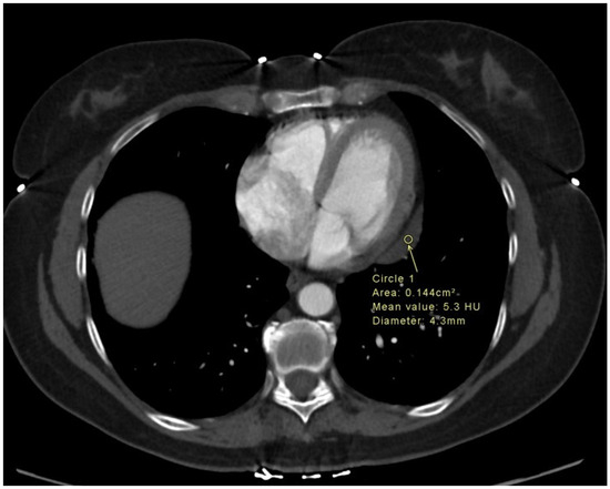 Contemporary Review of Clinical Features, Multi-Modality Imaging, and ...