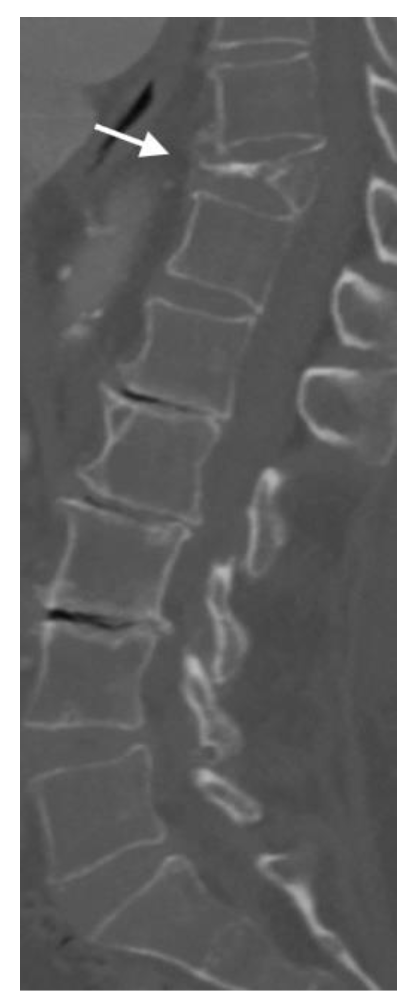 Radiological Diagnosis and Advances in Imaging of Vertebral Compression ...