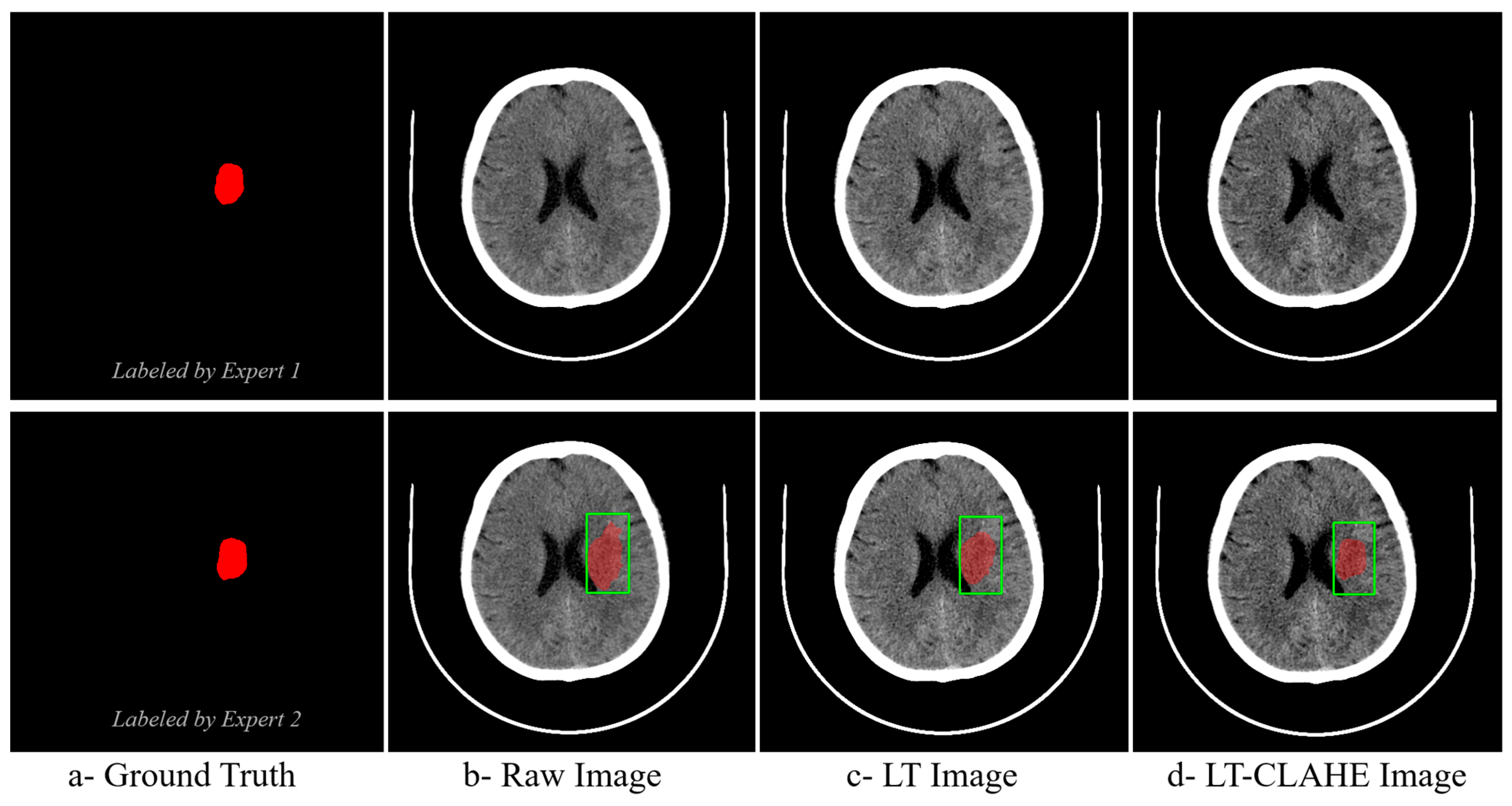 Optimized Hounsfield Units Transformation for Explainable Temporal ...