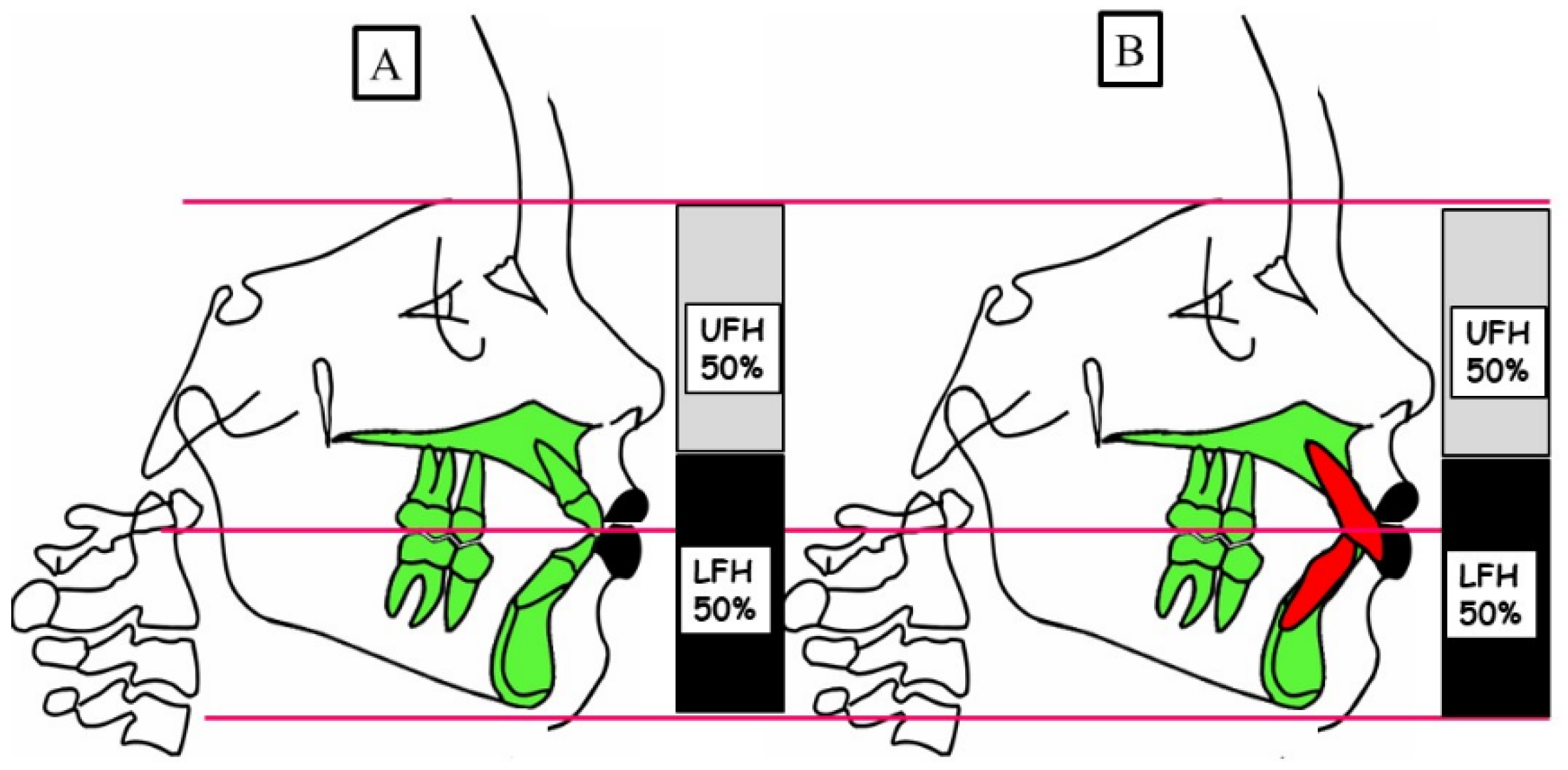 Comprehensive Deciphering the Complexity of the Deep Bite: Insight from ...