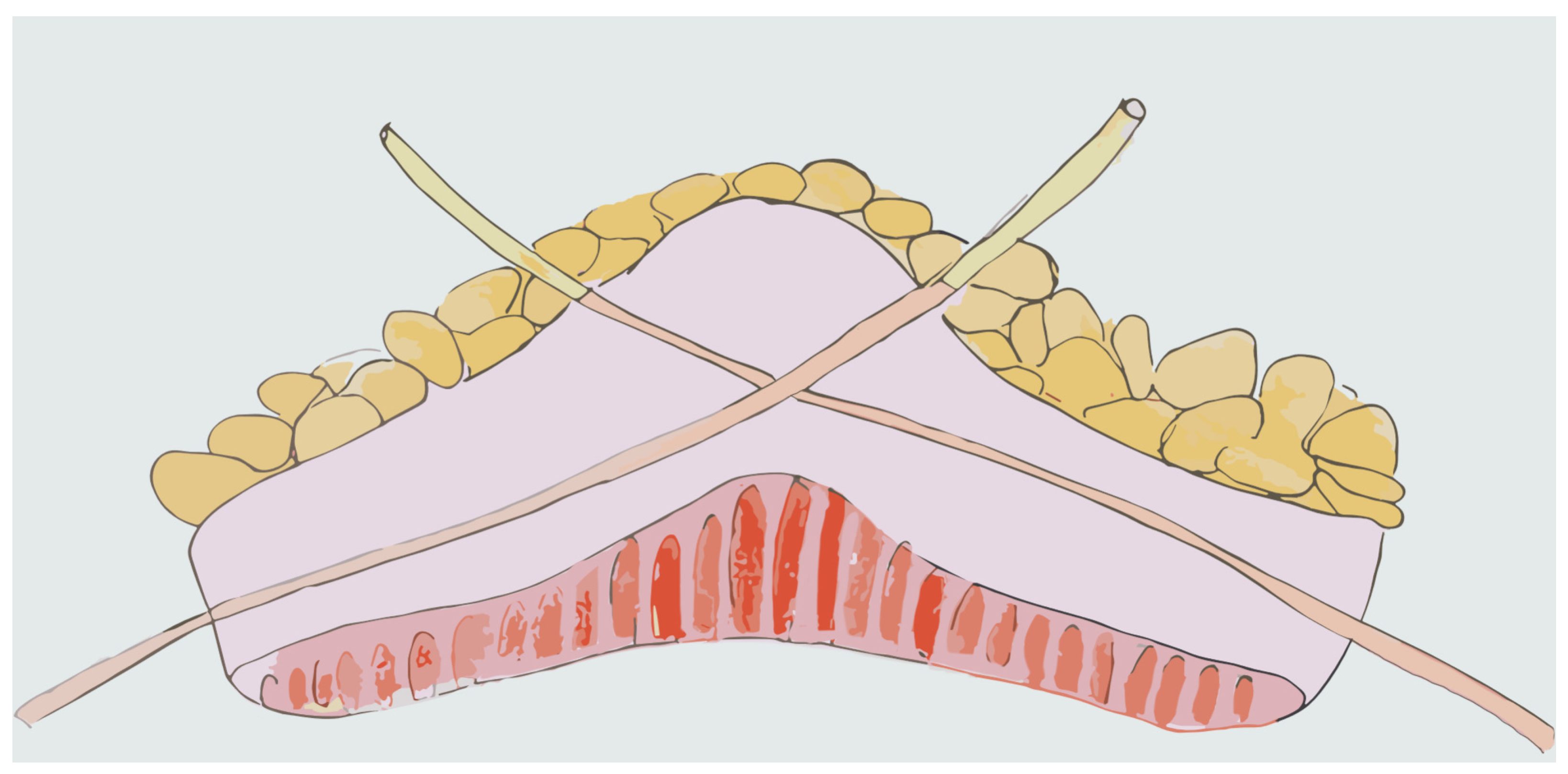 Advances in Urinary Diversion: From Cutaneous Ureterostomy to ...