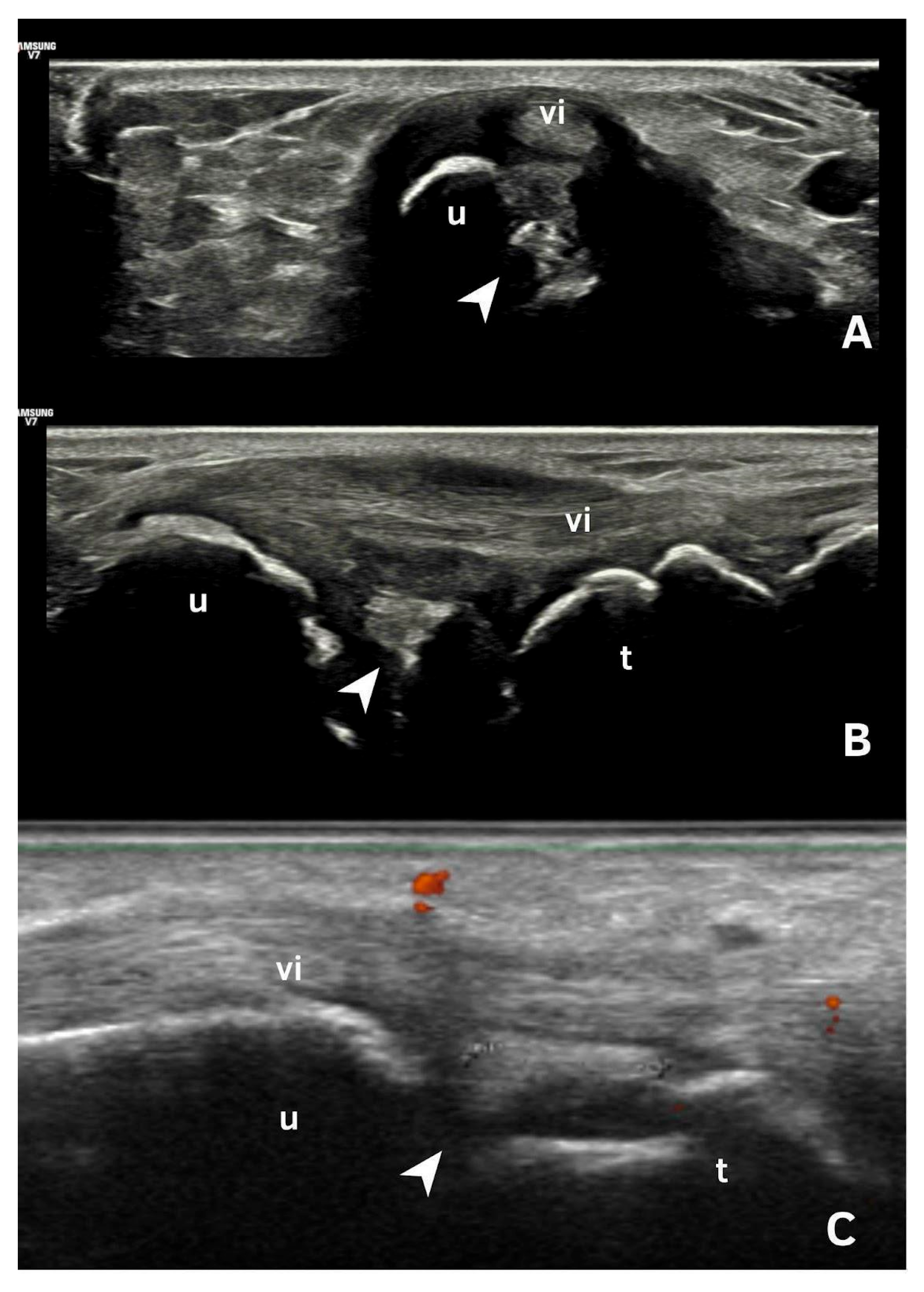 Ultrasonographic Assessment of Calcium Pyrophosphate Deposition Disease ...