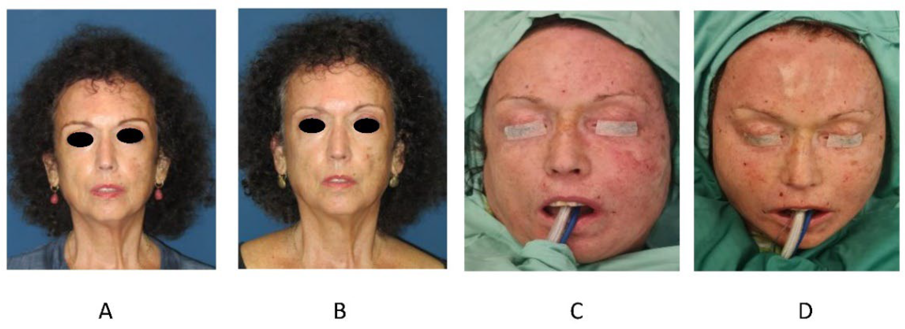 Total Facial Autologous Fat Grafting for Treating Skin Manifestations ...