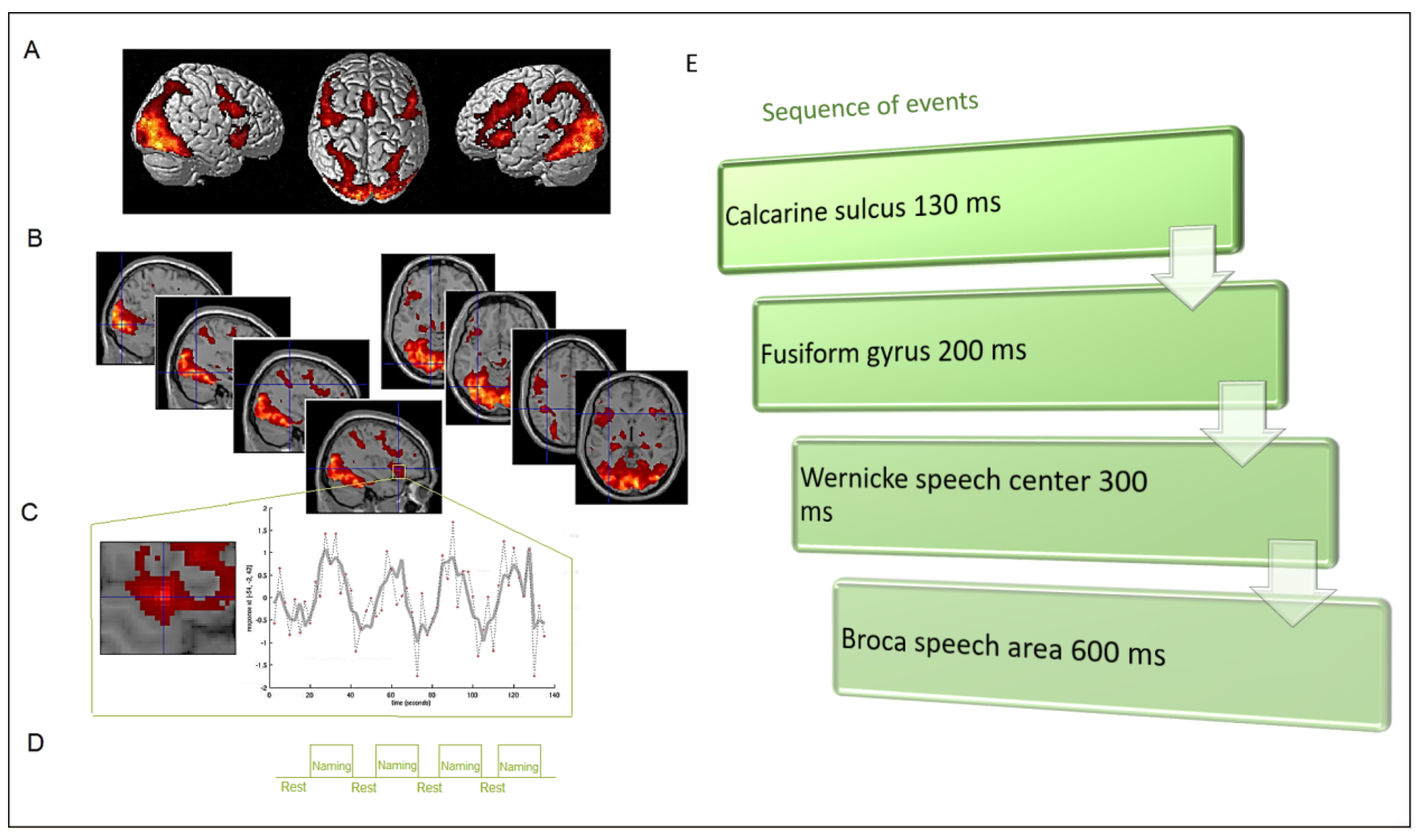 Pre-Operative Functional Mapping in Patients with Brain Tumors by fMRI ...