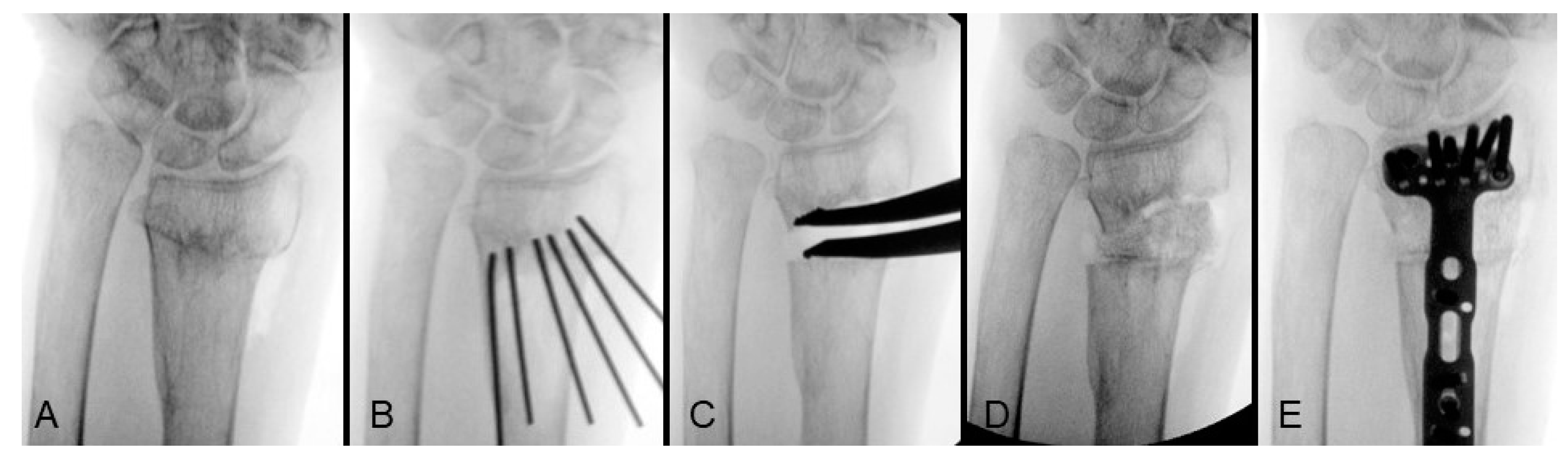 Management of Extra-Articular and Intra-Articular Distal Radius ...