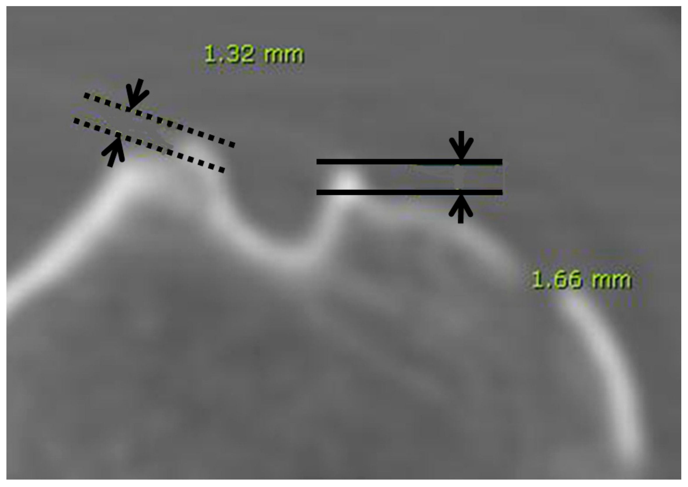 Anatomical Analysis of Bicipital Groove and Its Spur Formation Using 3D ...