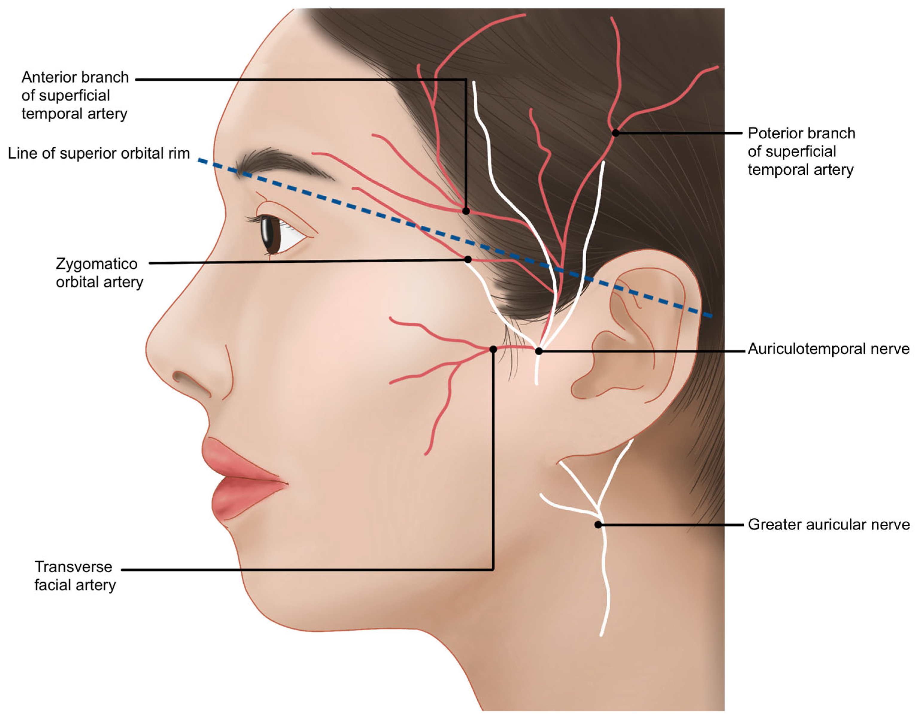 An Expert Guide to Anatomy-Based Filler Injection for the Temple ...
