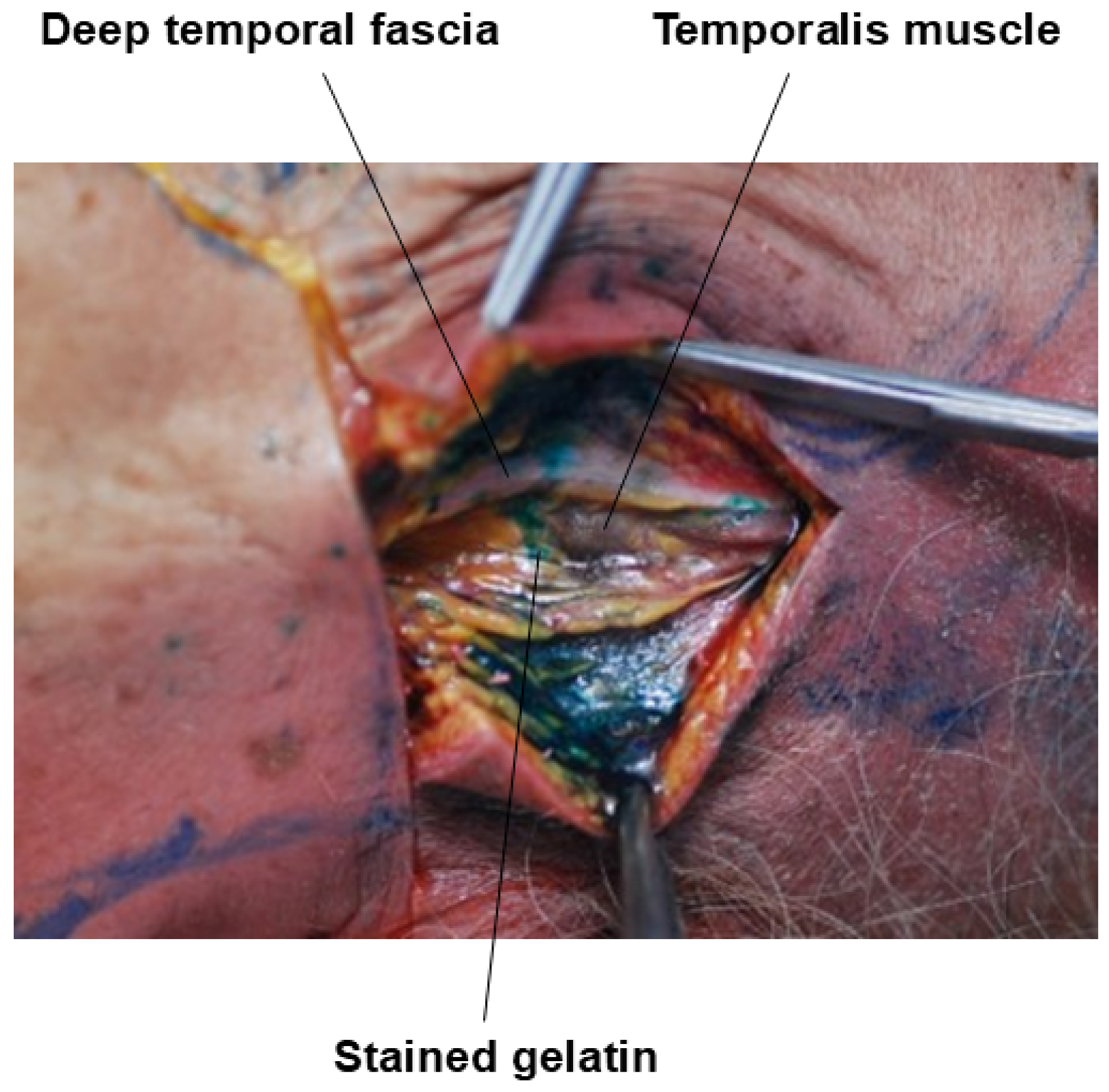 An Expert Guide to Anatomy-Based Filler Injection for the Temple ...
