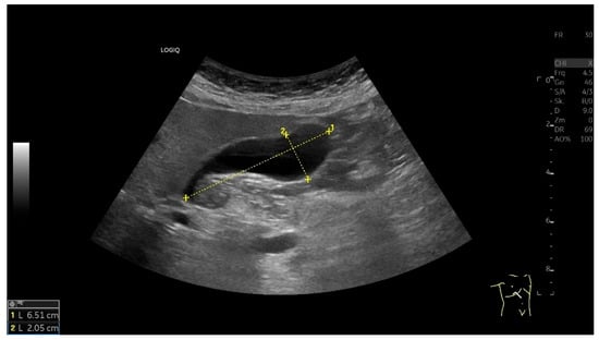 Ultrasound of the Gallbladder—An Update on Measurements, Reference ...