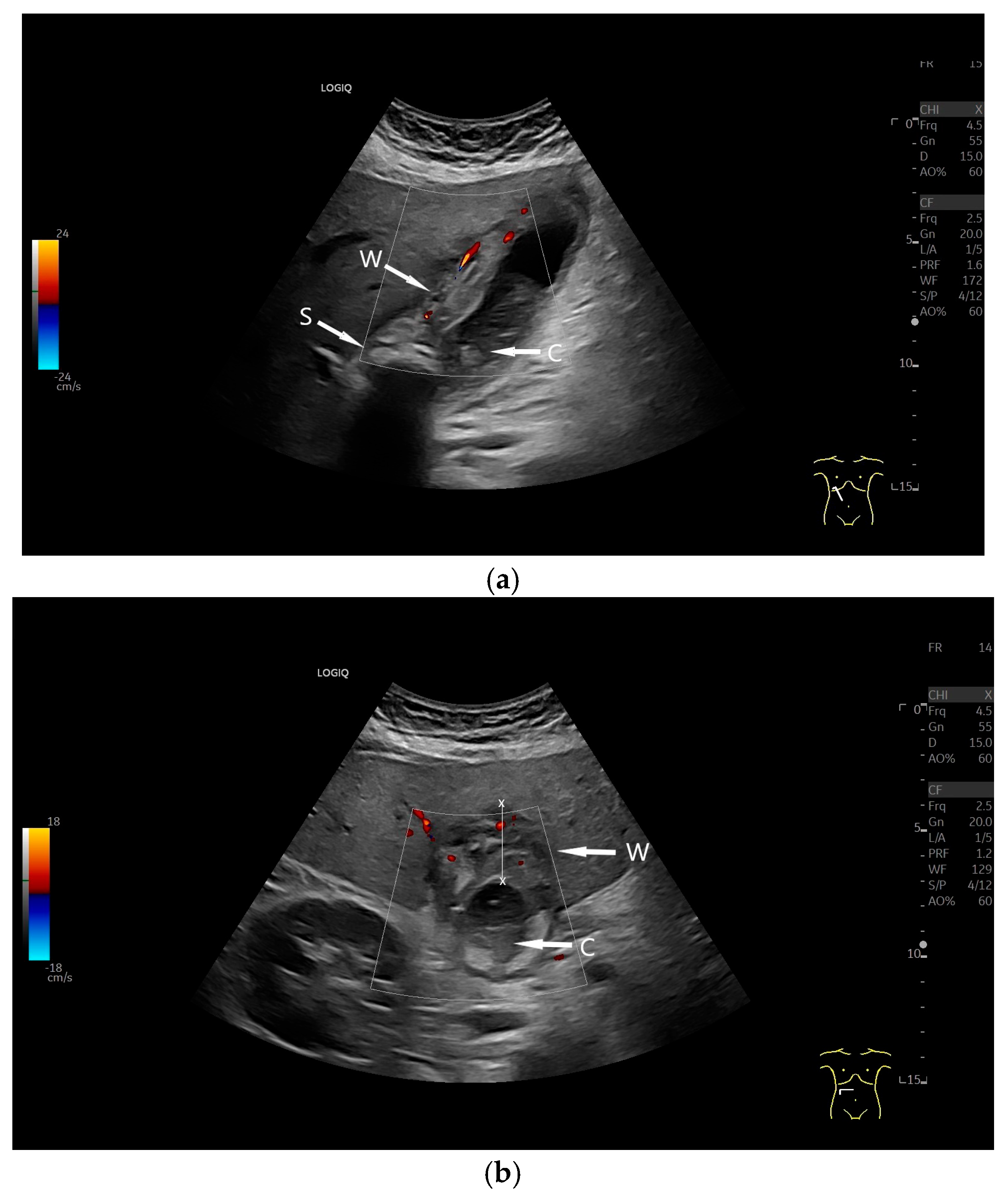 Ultrasound of the Gallbladder—An Update on Measurements, Reference ...