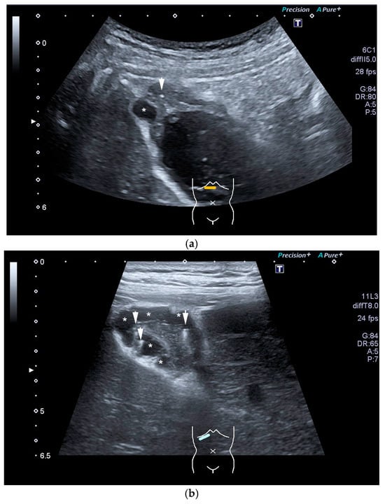 Ultrasound of the Gallbladder—An Update on Measurements, Reference ...