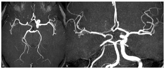 Neurovascular Issues in Neurofibromatosis Type I: Focus on Intracranial ...
