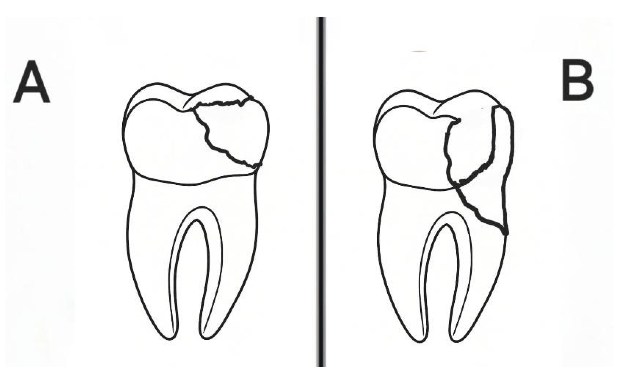 Fracture Resistance of Endodontically Treated Teeth Restored with ...