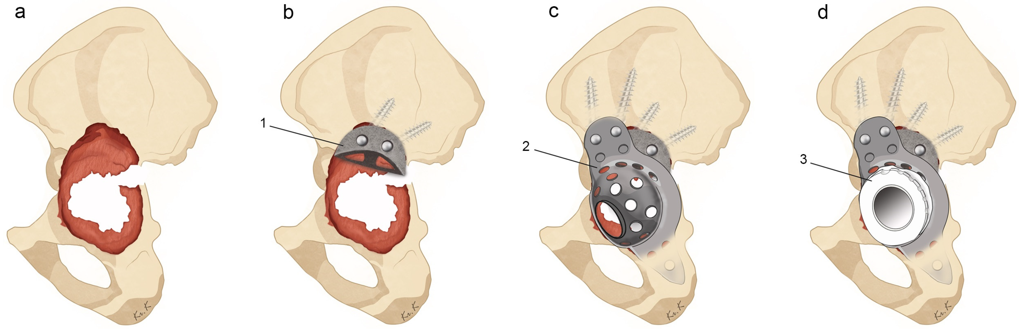 Revision Total Hip Arthroplasty Utilizing an Acetabular Reinforcement ...