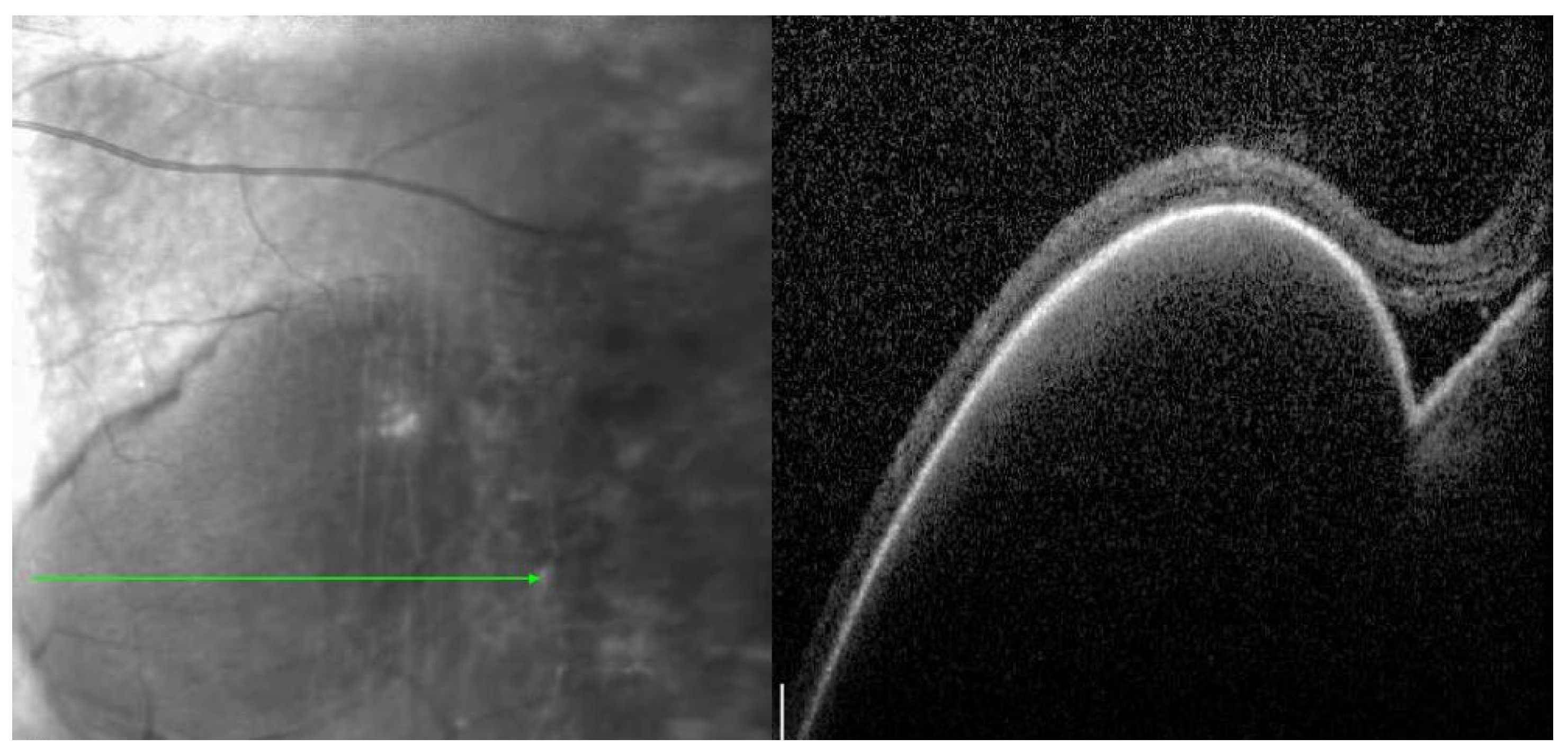 Peripheral Exudative Hemorrhagic Chorioretinopathy (PEHCR): Diagnostic ...