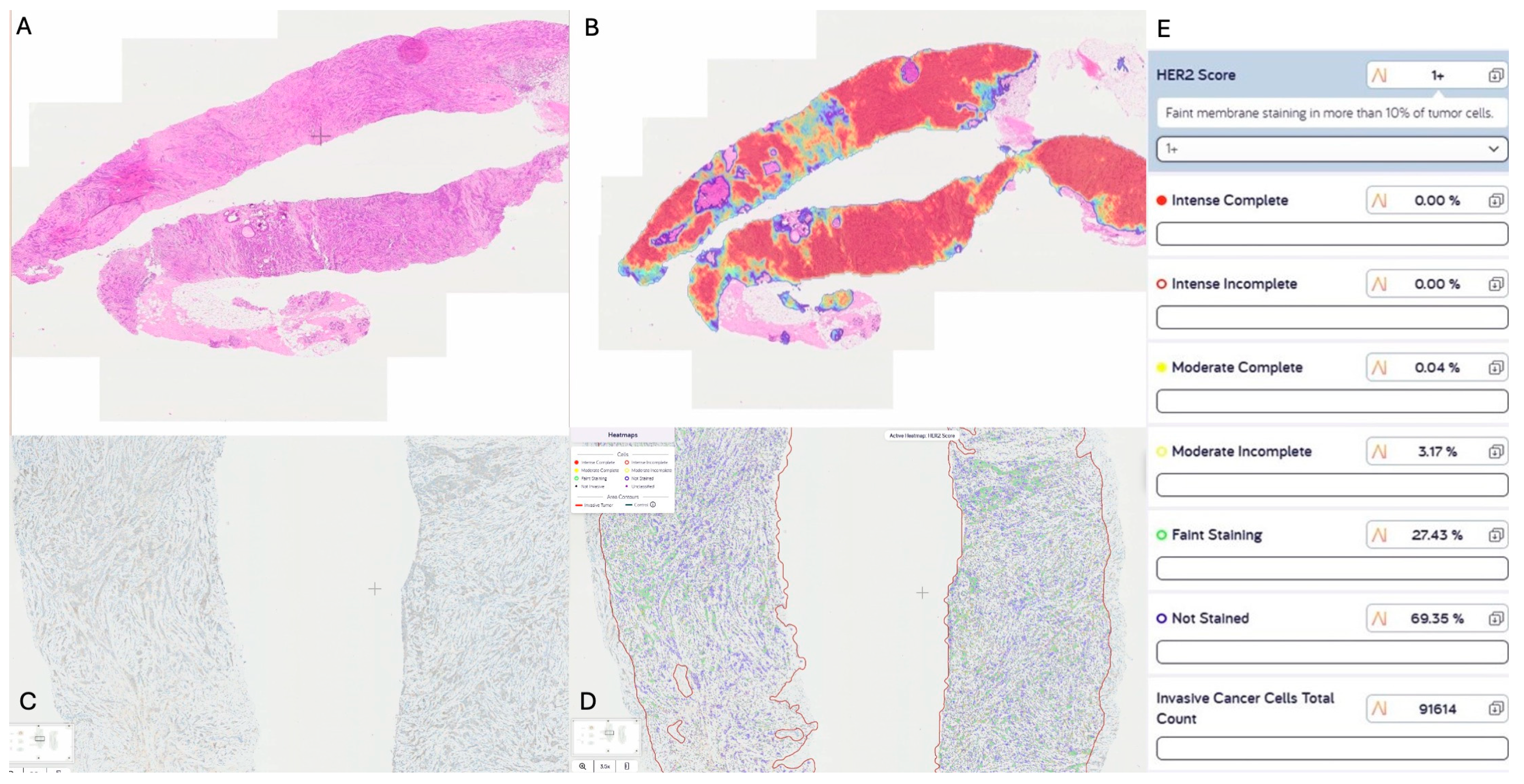 HER2-Low Breast Cancer—Current Knowledge and Future Directions | MDPI
