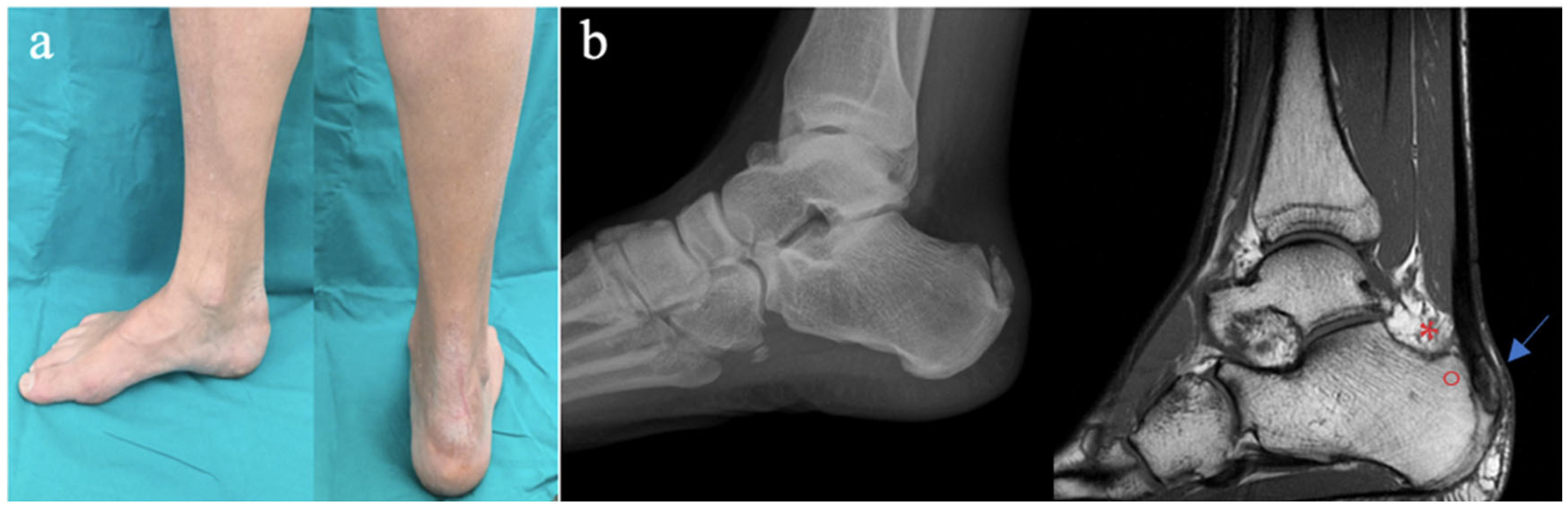 Successful Achilles Tendon Reattachment Using SpeedBridge in Haglund’s ...
