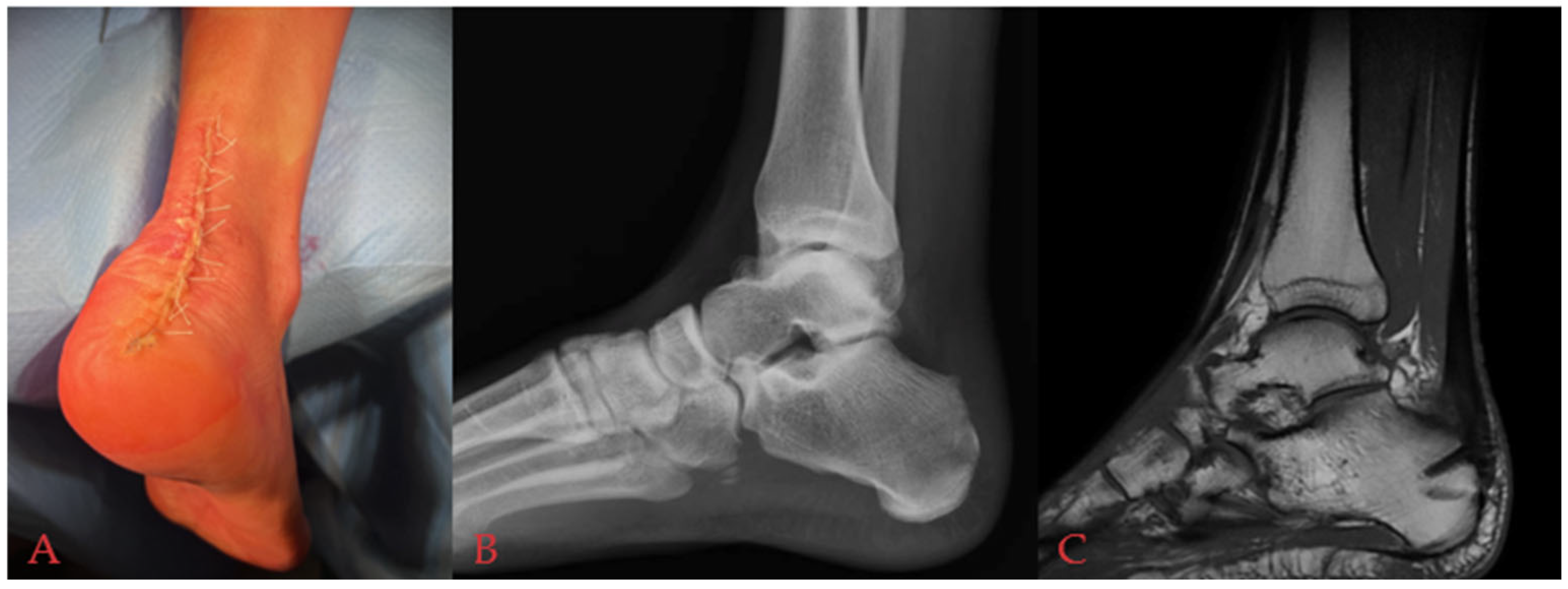 Successful Achilles Tendon Reattachment Using SpeedBridge in Haglund’s ...
