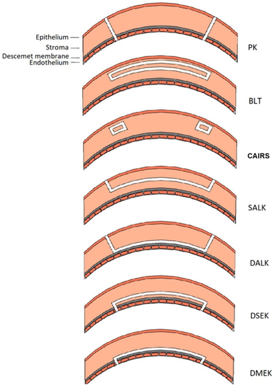 Corneal Allogeneic Intrastromal Ring Segments for Treating Keratoconus ...