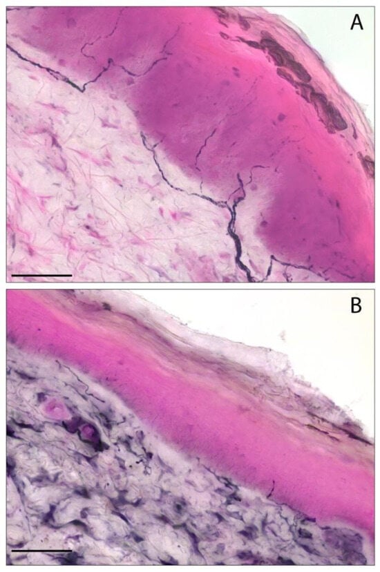 Post-COVID-19 Small Fiber Neuropathy as a New Emerging Quality of Life ...