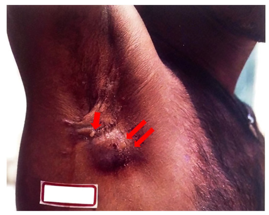 Cutaneous Manifestations of Mycobacterium tuberculosis: A Literature ...