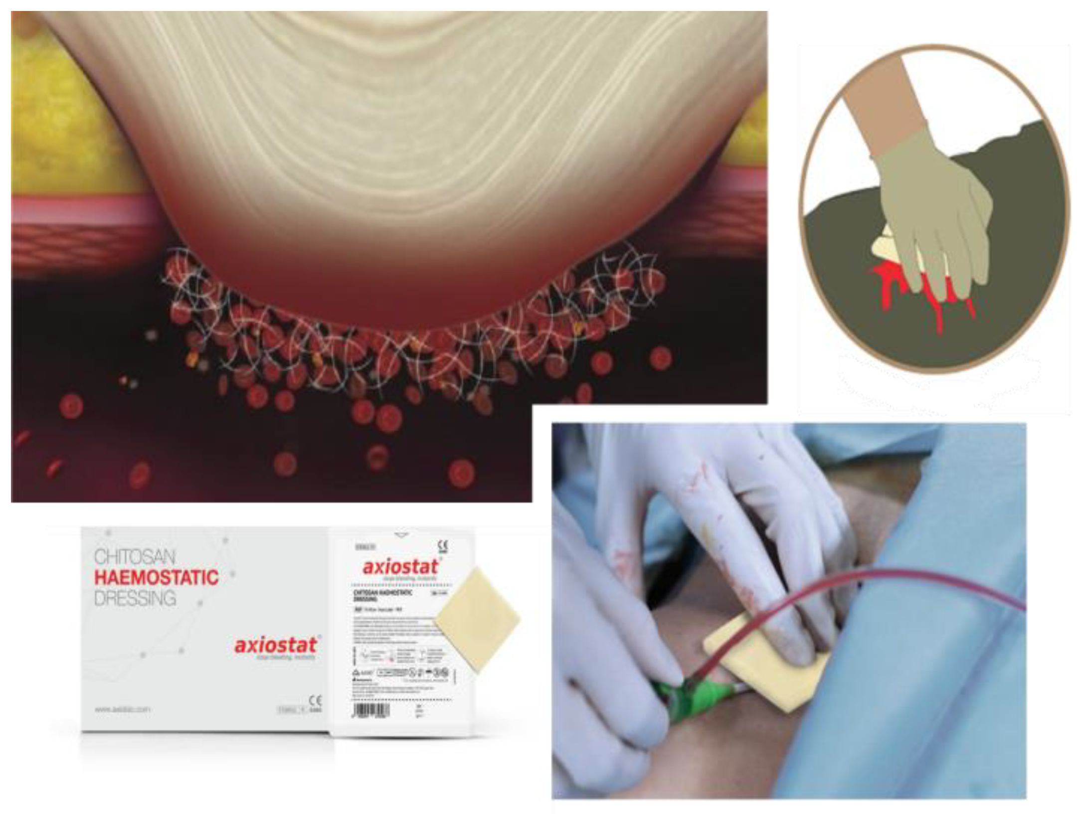 Chitosan Hemostatic Dressings: Properties and Surgical Applications | MDPI